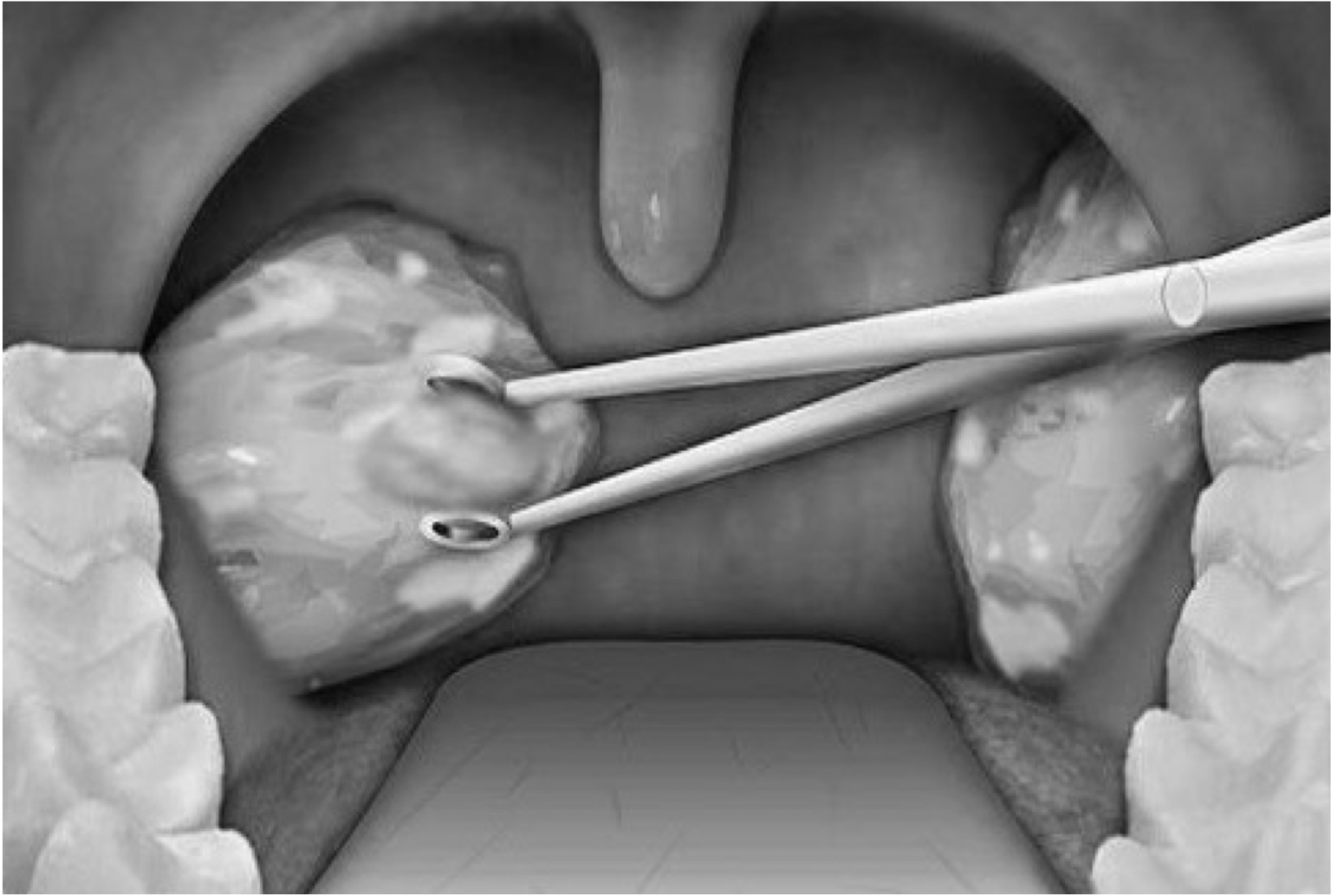 Mandelentfernung (Tonsillektomie) und Mandelverkleinerung ...